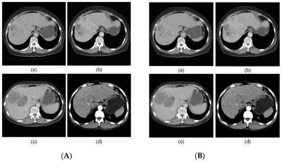 Liver CT Image Recognition Method Based on Capsule Network