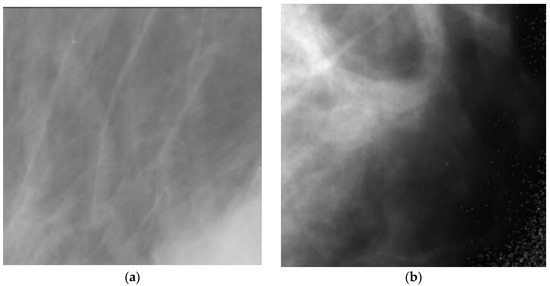 Breast Cancer Detection in Mammography Images: A CNN-Based Approach ...