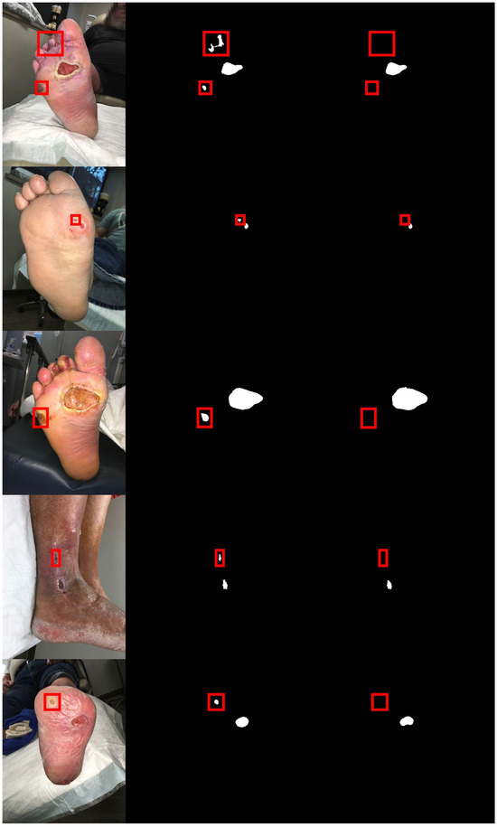 FUSeg: The Foot Ulcer Segmentation Challenge
