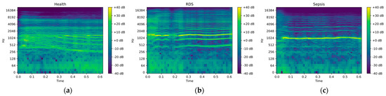 Transformer-Based Approach to Pathology Diagnosis Using Audio Spectrogram