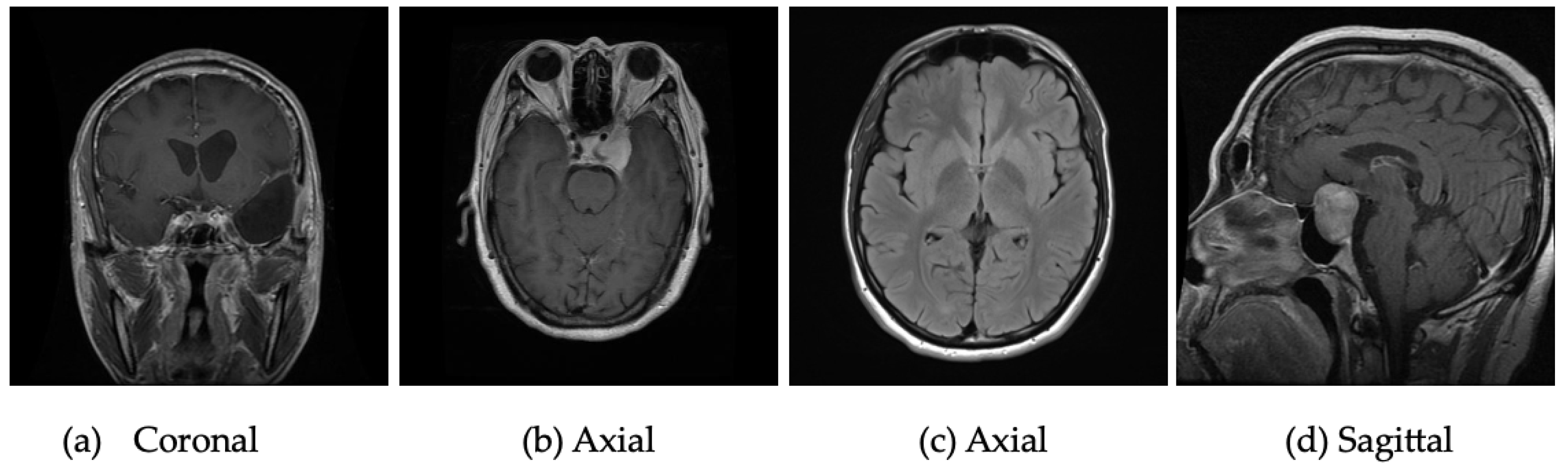 WGCAMNet: Wasserstein Generative Adversarial Network Augmented and Custom Attention Mechanism ...