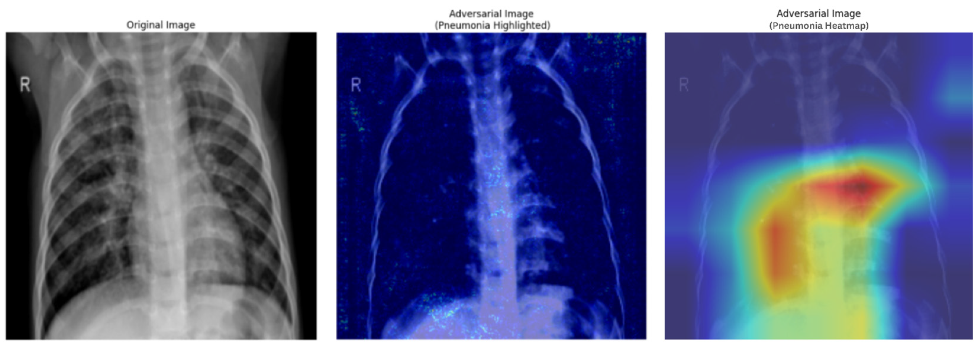 Interpretable Deep Learning for Pneumonia Detection Using Chest X-Ray ...