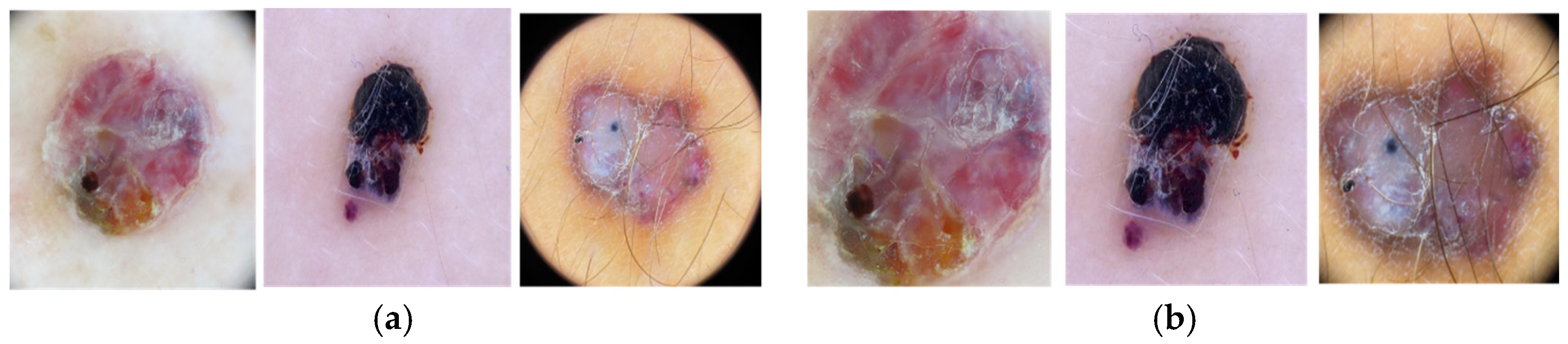 Attention-Based Inception-Residual CNN: Skin Cancer Diagnosis with ...