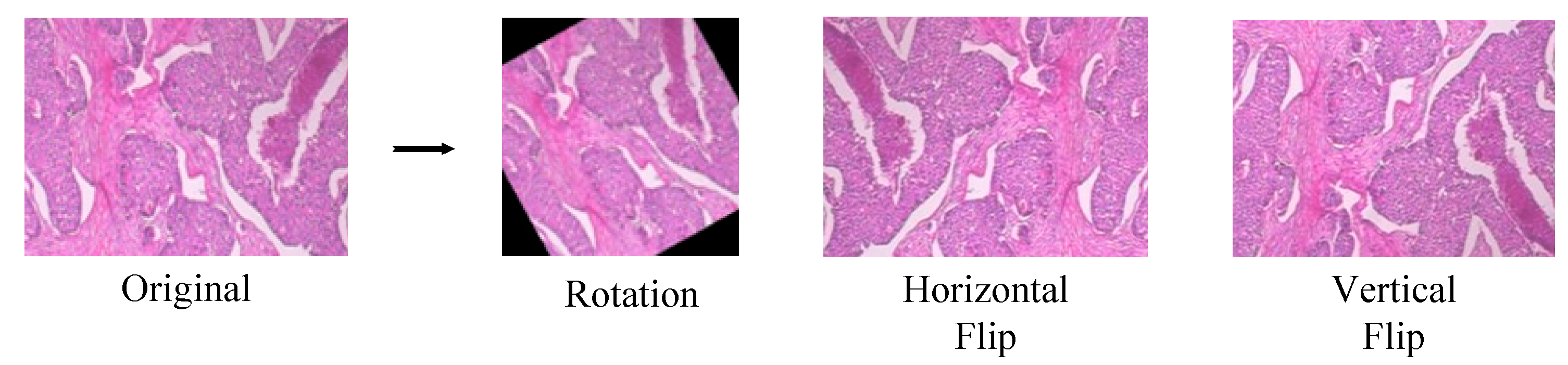 Focal Cosine-Enhanced EfficientNetB0: A Novel Approach to Classifying Breast Histopathological ...