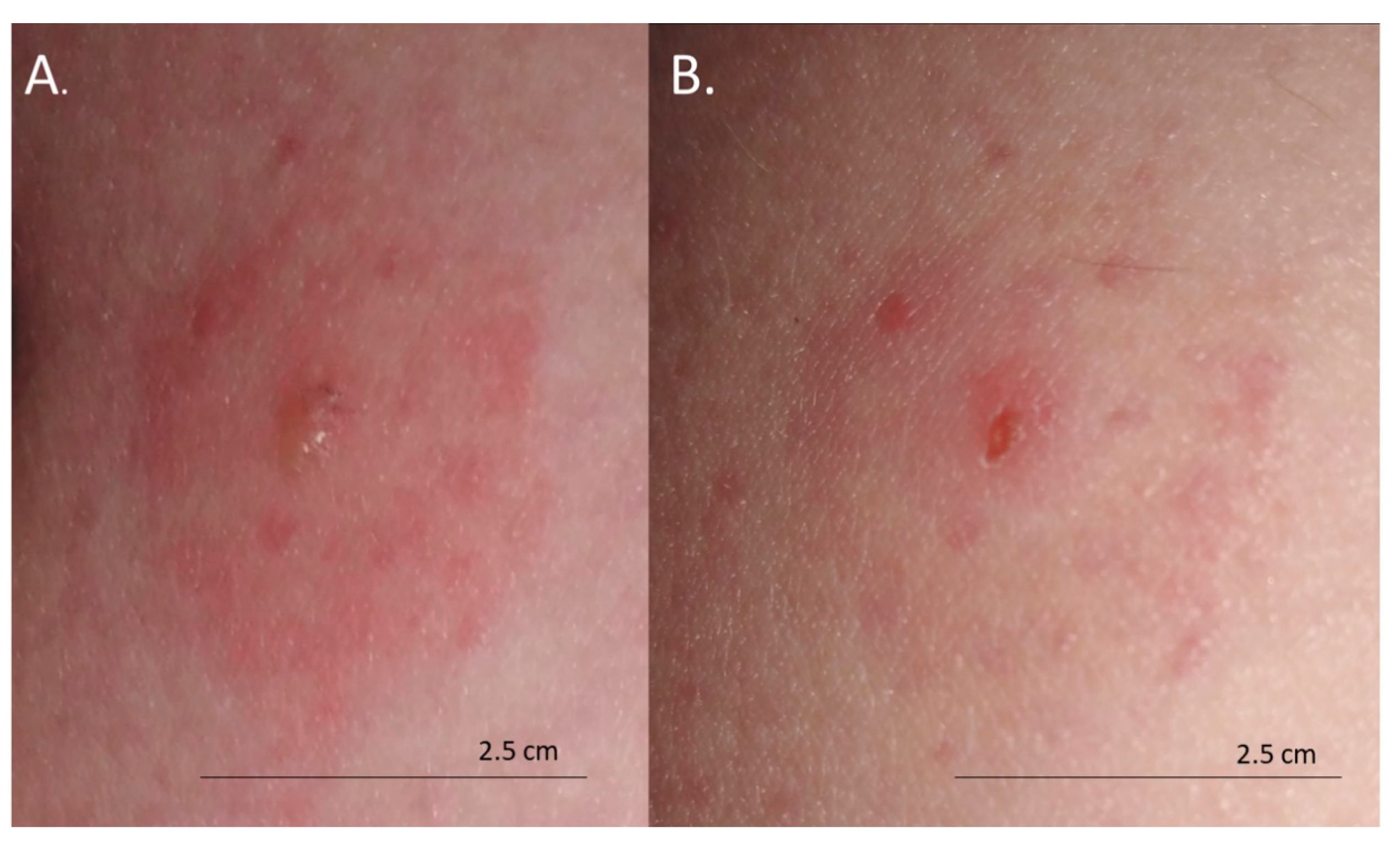 Exposure of Humans to Attacks by Deer Keds and Consequences of Their ...