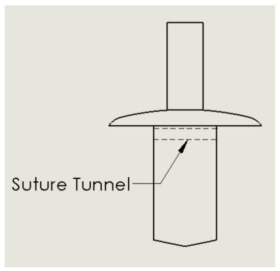 Endoscopic Forehead Lifting with a Novel Polymer Fixation Peg: A Case ...
