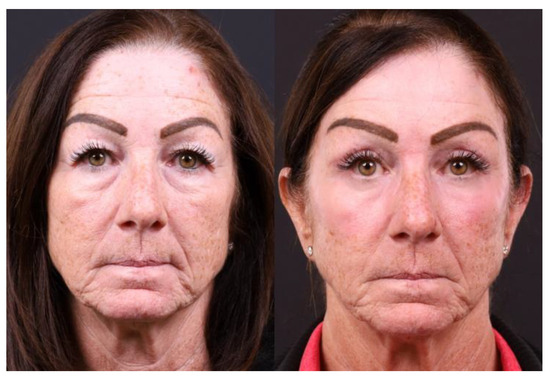 Endoscopic Forehead Lifting with a Novel Polymer Fixation Peg: A Case ...