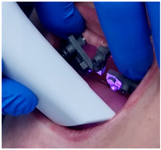 AI-Driven Aesthetic Rehabilitation in Edentulous Arches: Advancing ...