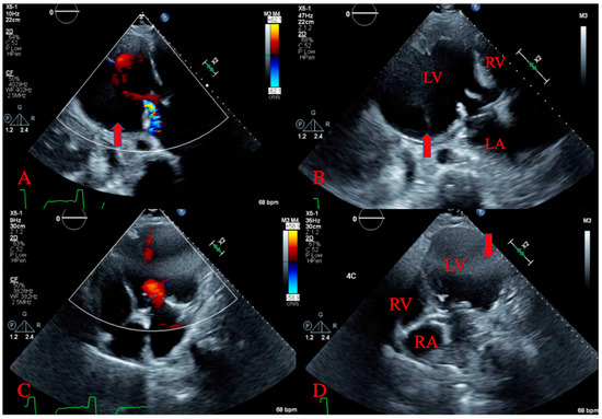Pseudoaneurysm Development after Free Wall Rupture Post Myocardial ...