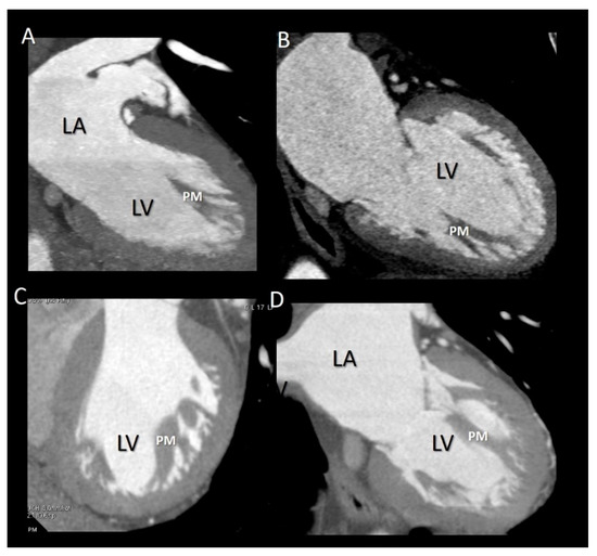 Anatomy of Mitral Valve Complex as Revealed by Non-Invasive Imaging ...