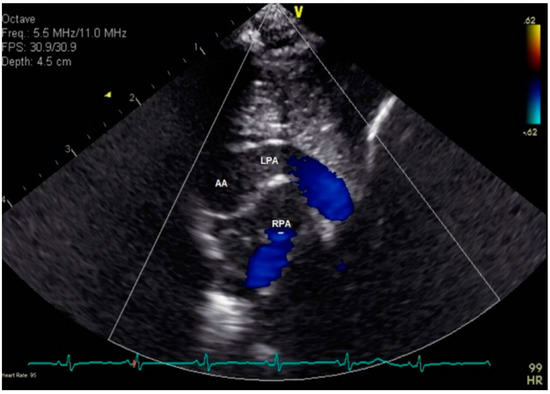 Left Pulmonary Artery from the Ascending Aorta: A Case Report and ...