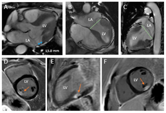 Characterization of Degenerative Mitral Valve Disease: Differences ...