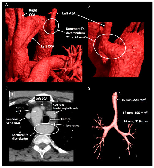 The Clinical Spectrum of Kommerell’s Diverticulum in Adults with a ...