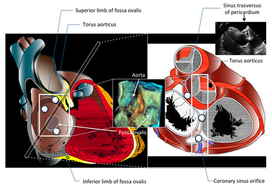 Transcatheter Closure of PFO and ASD: Multimodality Imaging for Patient ...
