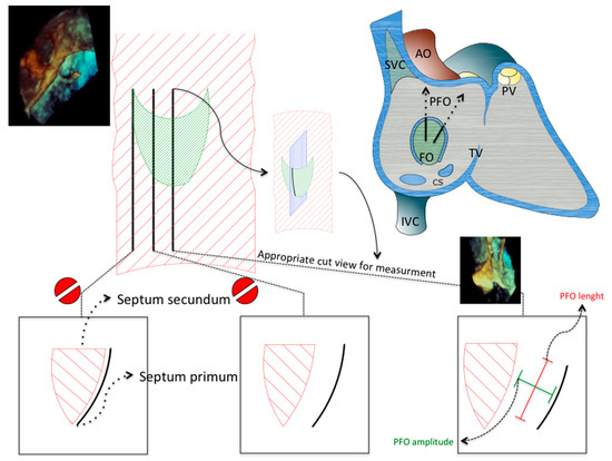 Transcatheter Closure of PFO and ASD: Multimodality Imaging for Patient ...