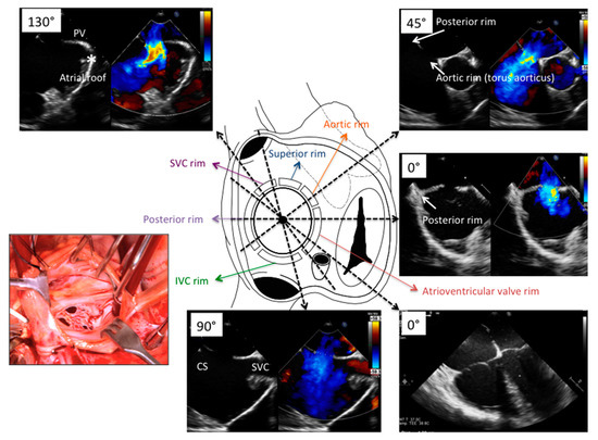 JCDD | Free Full-Text | Transcatheter Closure of PFO and ASD ...