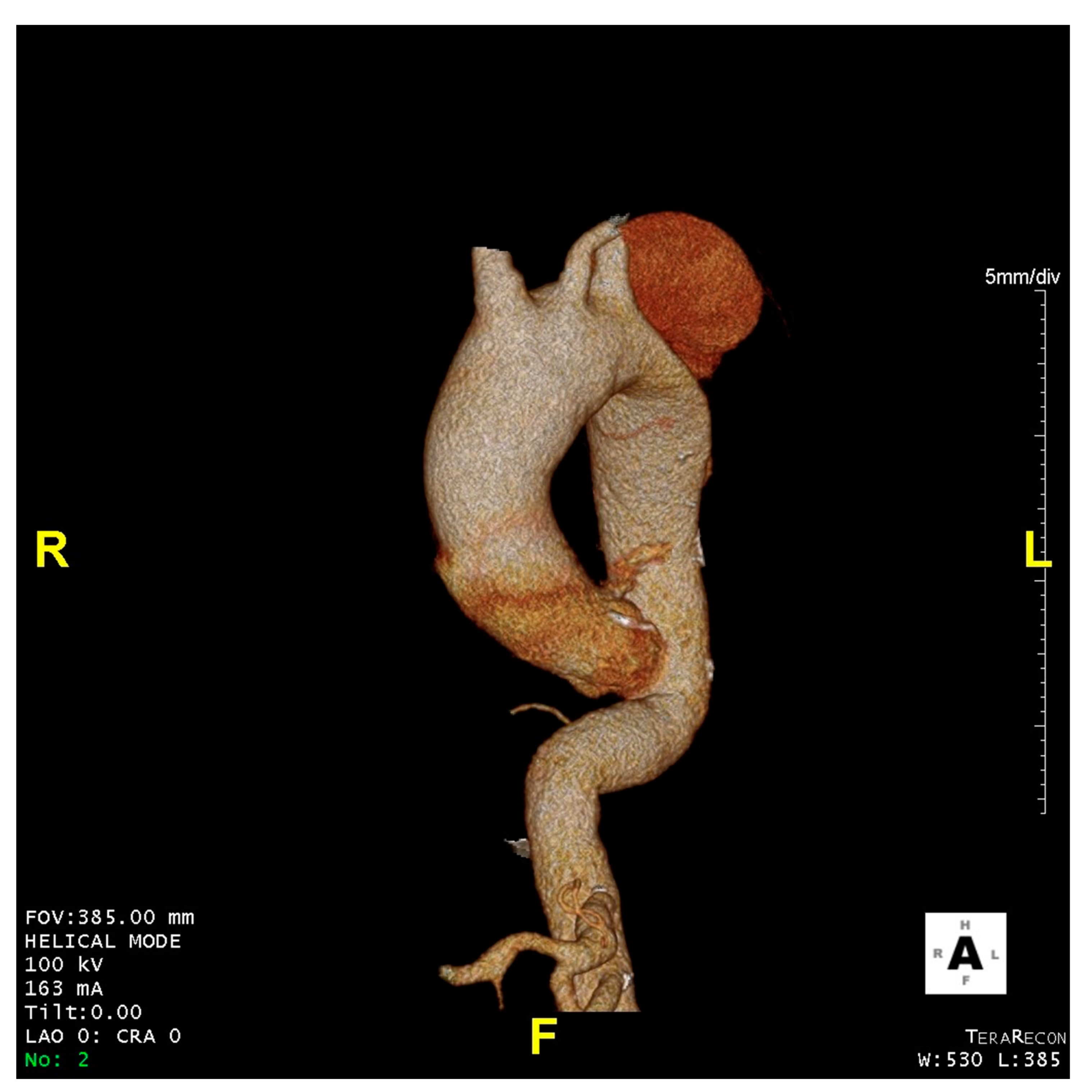 Alternative Approach for Cerebral Protection during Complex Aortic Arch ...