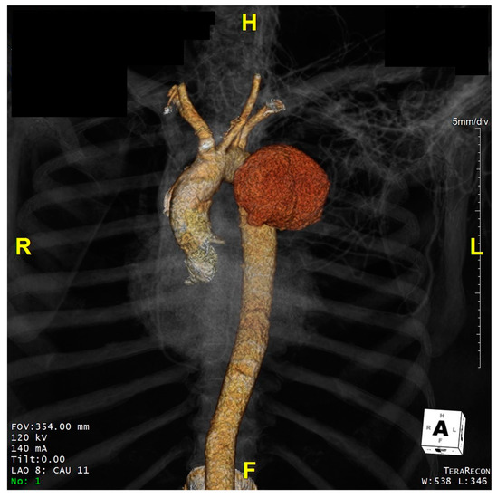 Alternative Approach for Cerebral Protection during Complex Aortic Arch ...