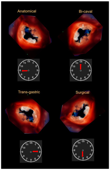 Multimodality Imaging of the Anatomy of Tricuspid Valve
