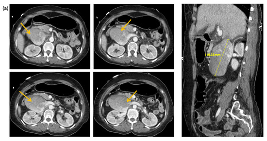 A Unique Case of Inferior Vena Cava Aneurysm Complicated with Pulmonary ...