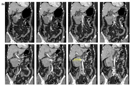 A Unique Case of Inferior Vena Cava Aneurysm Complicated with Pulmonary ...