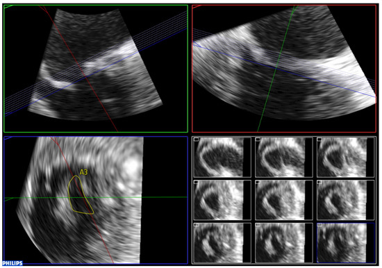 The Role of 2D and 3D Echo in Mitral Stenosis