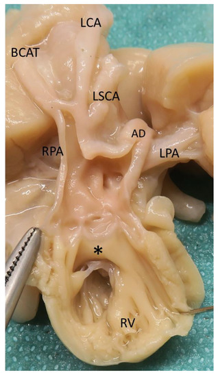 Common Arterial Trunk Associated with Functionally Univentricular Heart ...