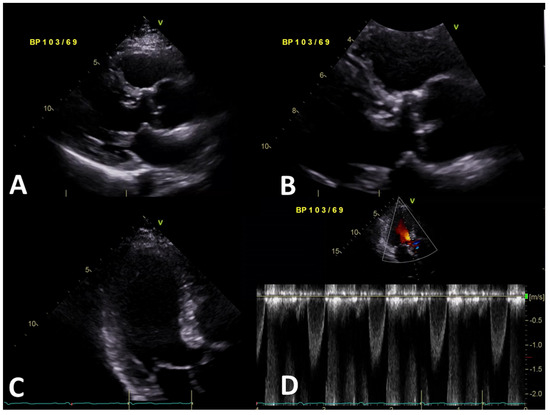 Adult Presentation of Subaortic Stenosis with Subaortic Membrane ...