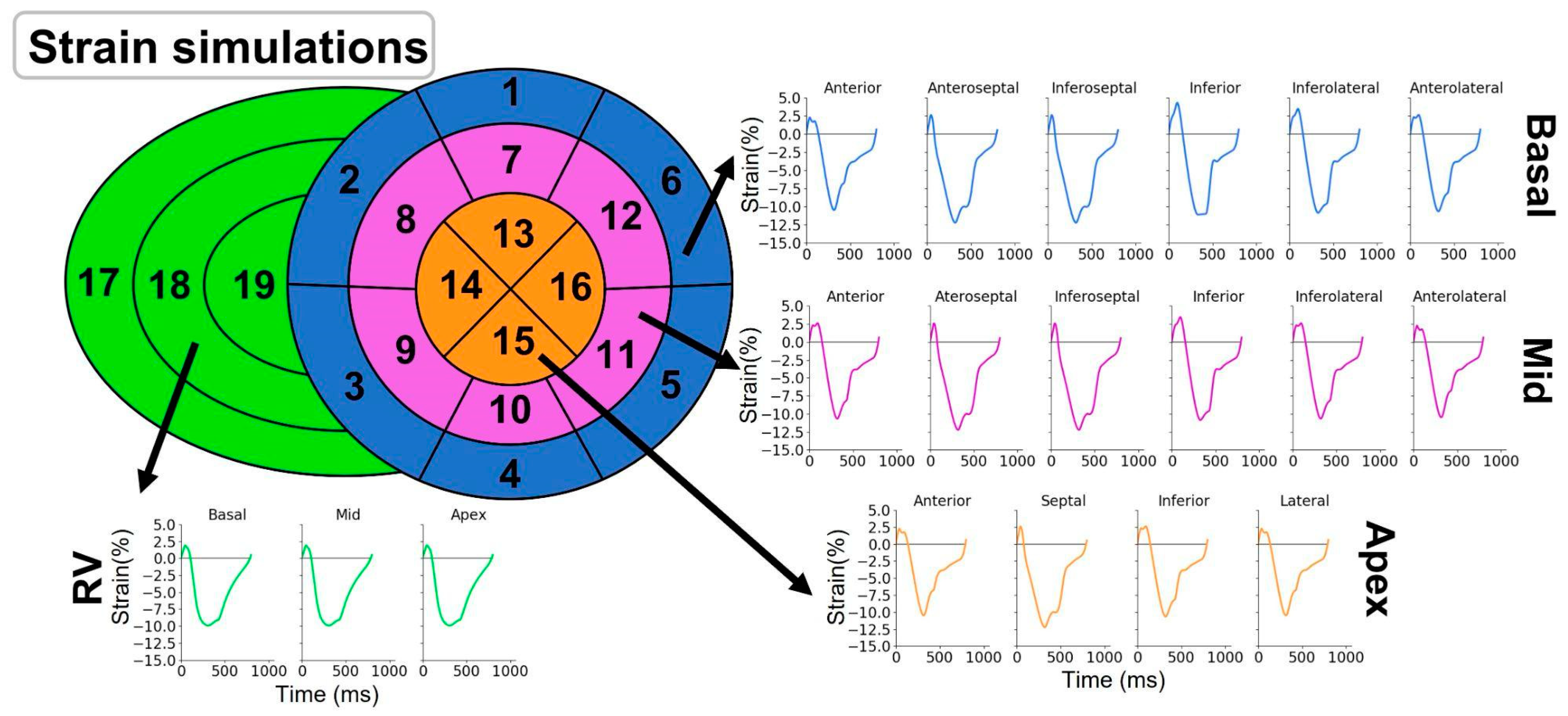 Desynchronization Strain Patterns and Contractility in Left Bundle ...