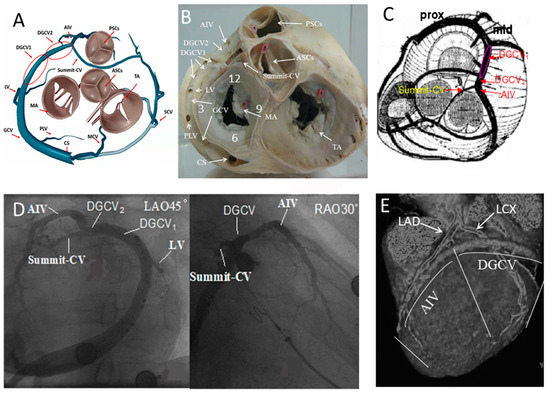 Idiopathic Ventricular Arrhythmias Originating from Different Portions ...