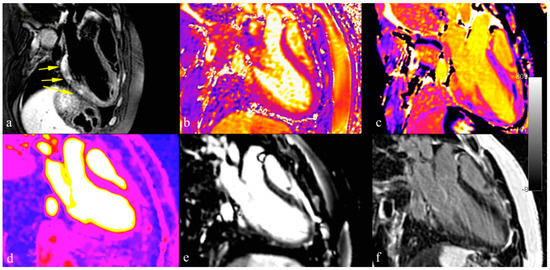 Pediatric Myocarditis: What Have We Learnt So Far?