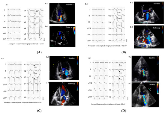 Impact of S-Wave Amplitude in Right Precordial Leads on Improvement in ...