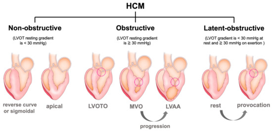 Contemporary Diagnosis and Management of Hypertrophic Cardiomyopathy ...