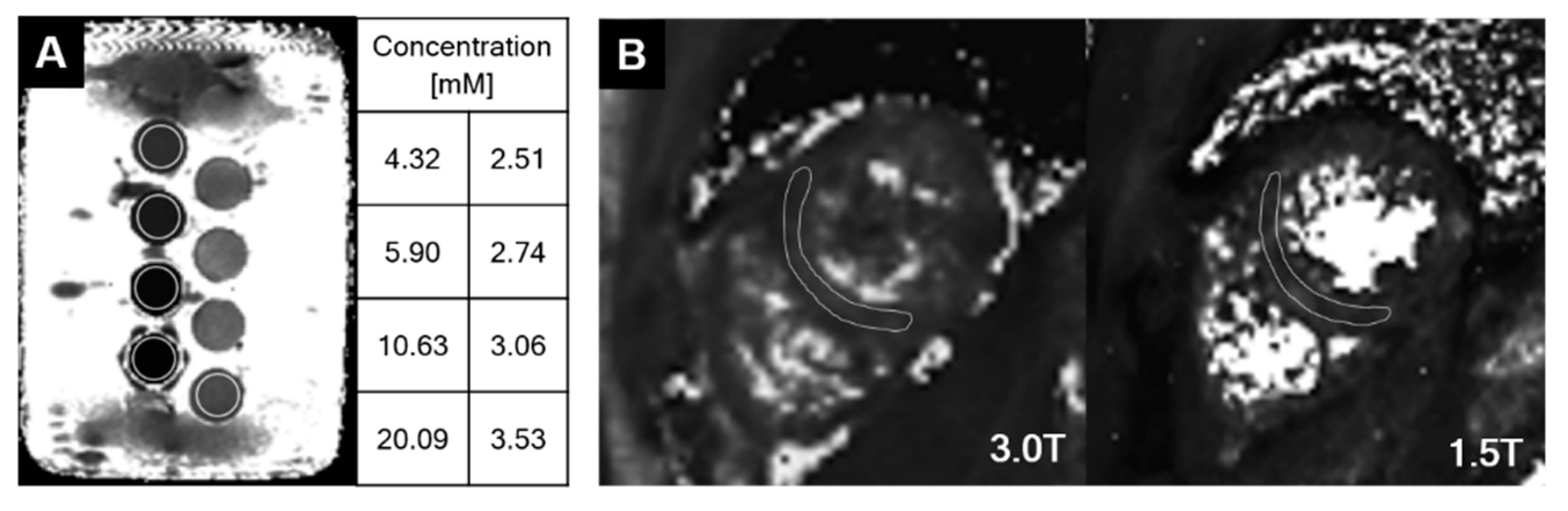 Myocardial T2* Imaging at 3T and 1.5T: A Pilot Study with Phantom and ...