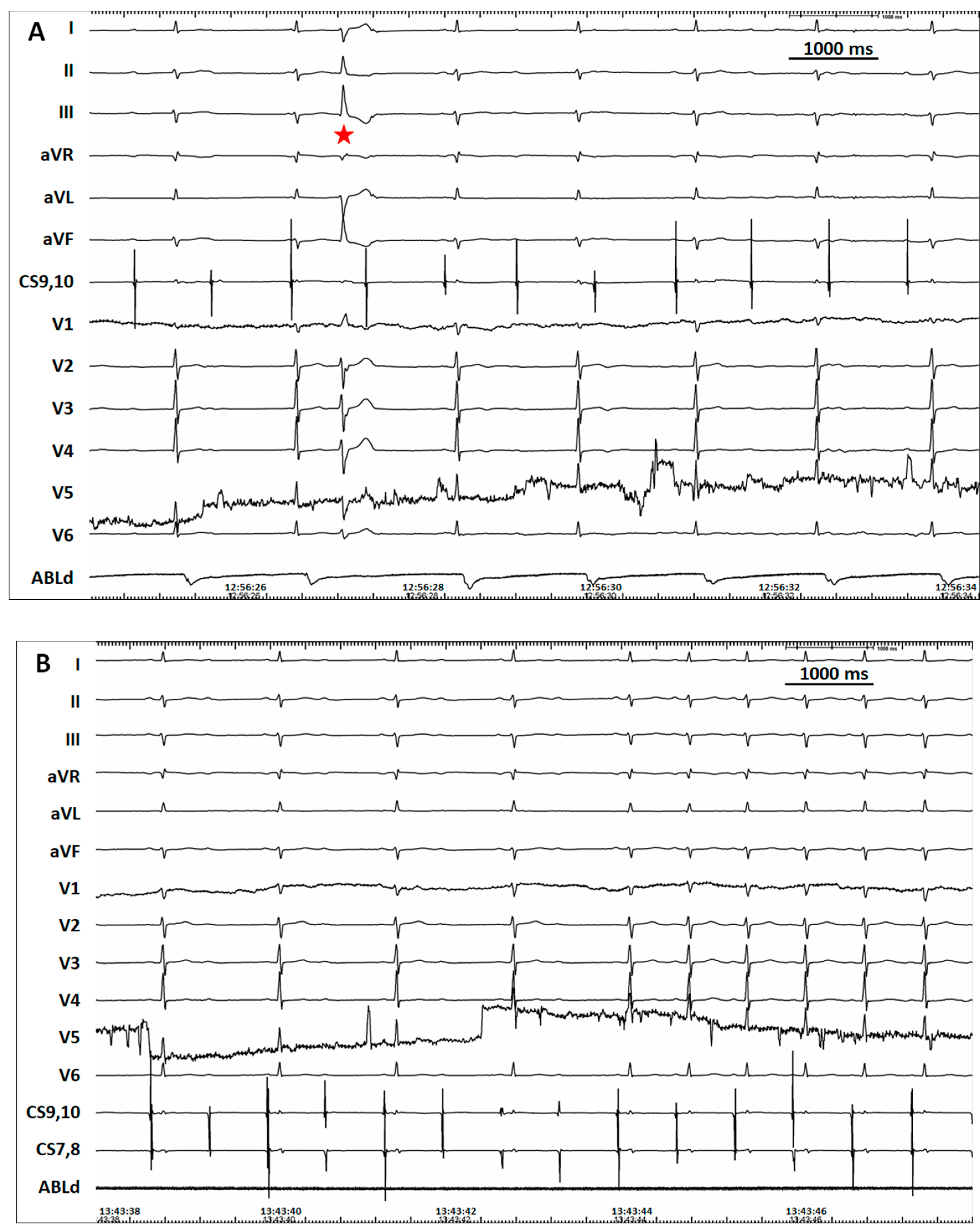 Complete Atrioventricular Block Caused by Retrograde Transaortic Approach