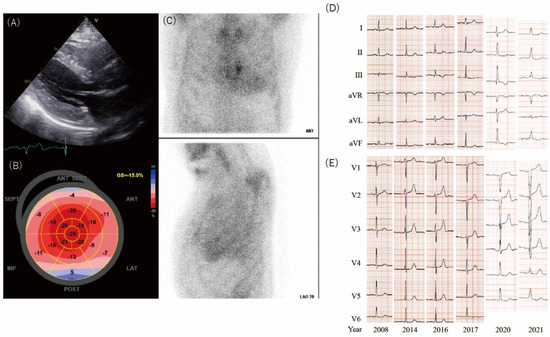 JCDD | Free Full-Text | Summation of Precordial R Wave Amplitudes, a ...