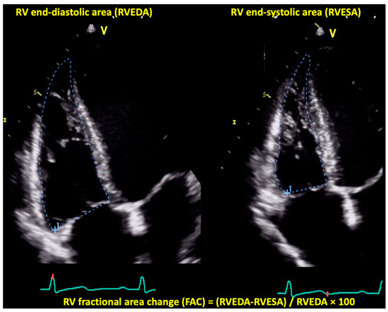 The Dysfunctional Right Ventricle in Dilated Cardiomyopathies: Looking ...