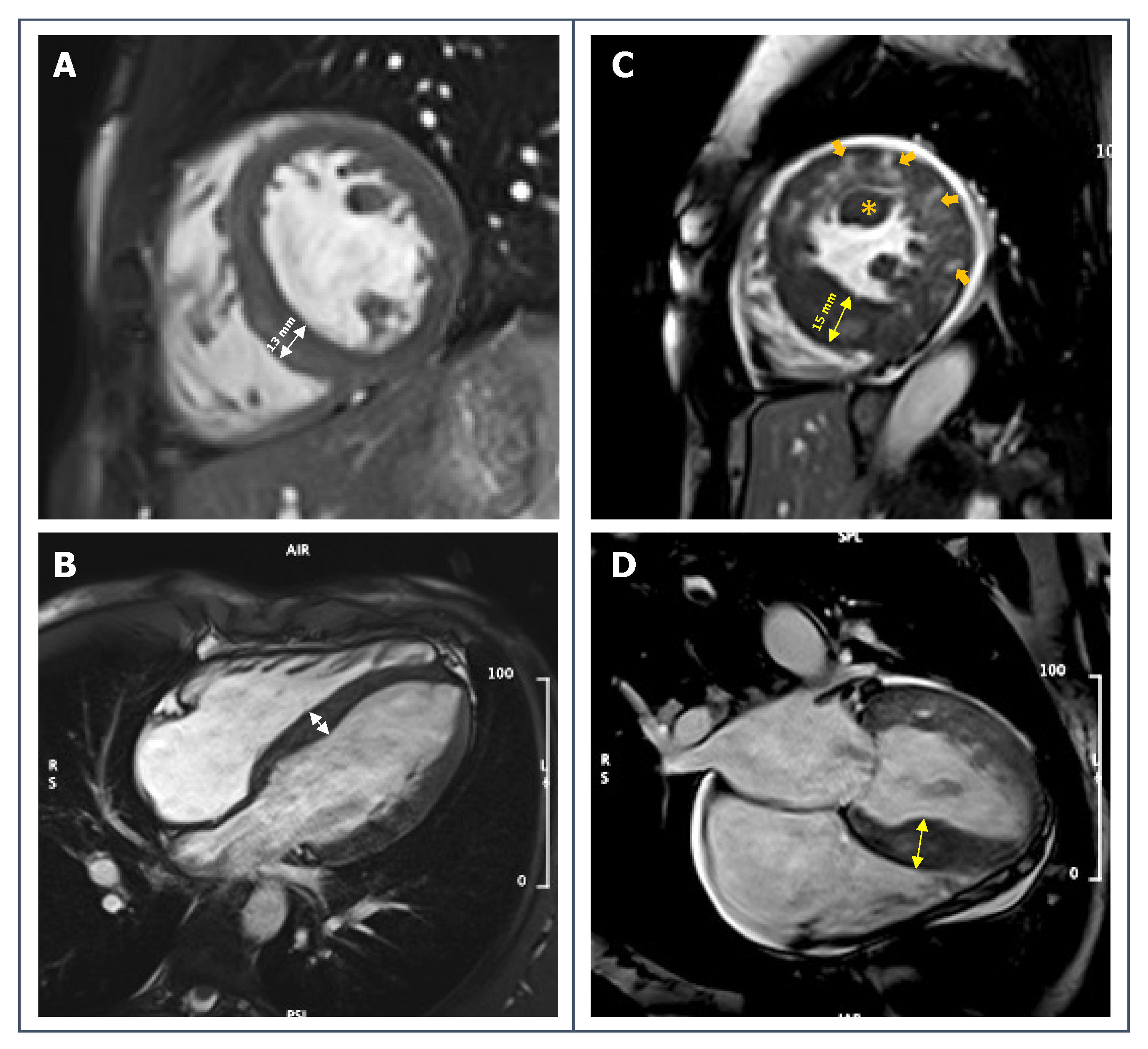 Certainties and Uncertainties of Cardiac Magnetic Resonance Imaging in ...