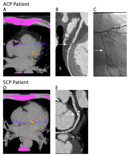 The Added Value of a High CT Coronary Artery Calcium Score in the ...