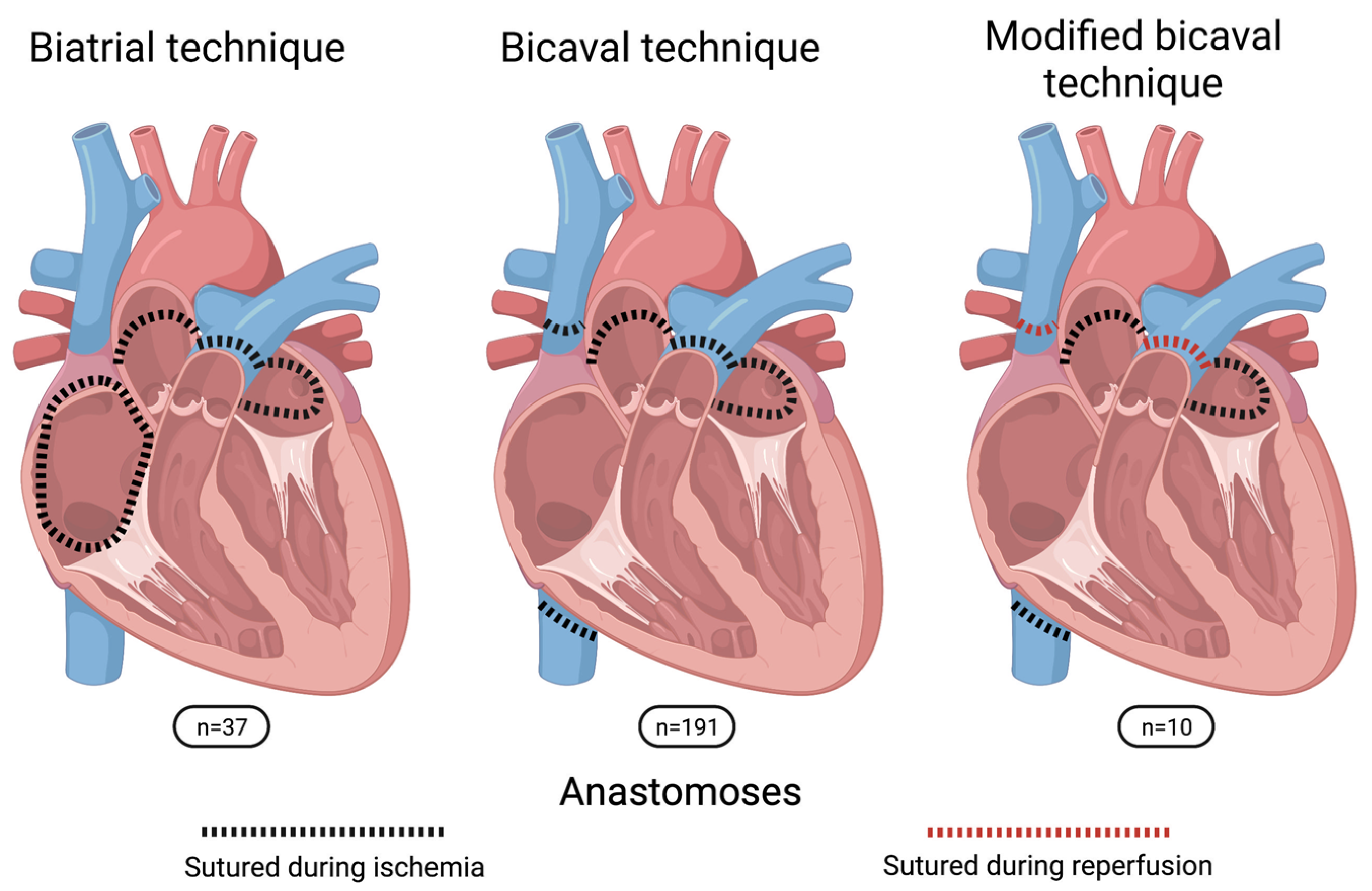 Jcdd Free Full Text Optimizing Anastomoses Technique In Orthotopic