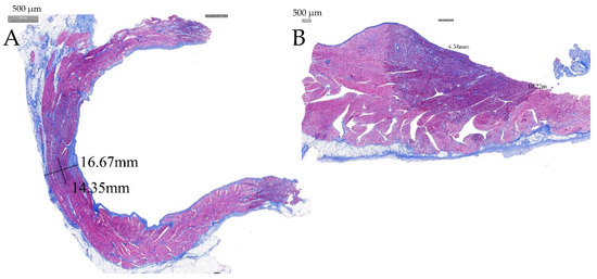 Pulsed-Field Ablation Using a Novel Ablation-Mapping Integrated System ...