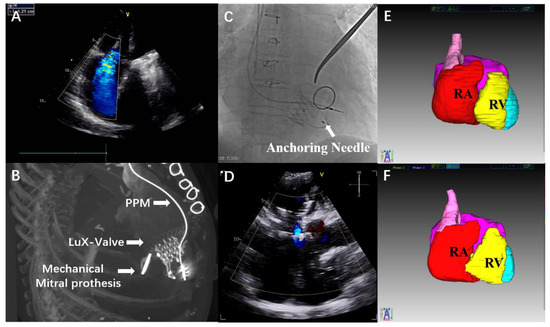 4-Year Follow-Up after Transatrial Transcatheter Tricuspid Valve ...