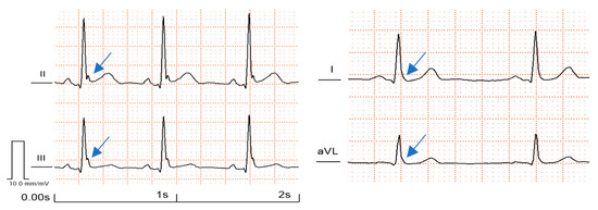 Cardiac Morphofunctional Characteristics of Individuals with Early ...