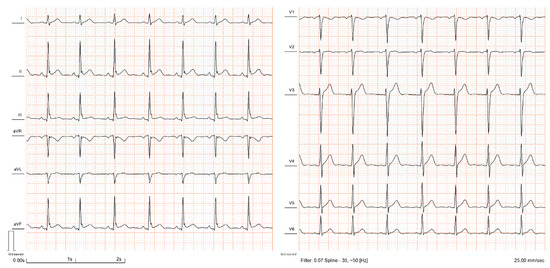 Cardiac Morphofunctional Characteristics of Individuals with Early ...