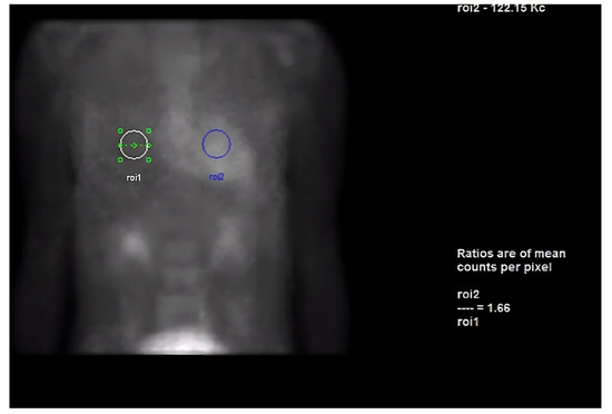 Cardiac Amyloidosis: A Rare TTR Mutation Found in an Asian Female