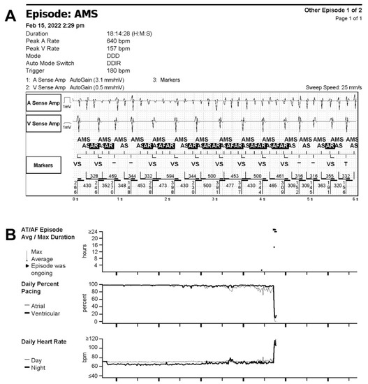 Early Smartphone App-Based Remote Diagnosis of Silent Atrial ...