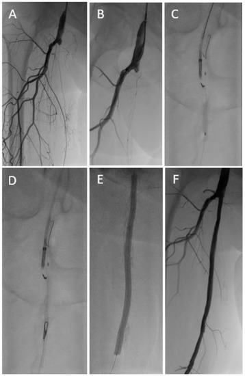 Target Balloon-Assisted Antegrade and Retrograde Use of Re-Entry Catheters in Complex Chronic ...