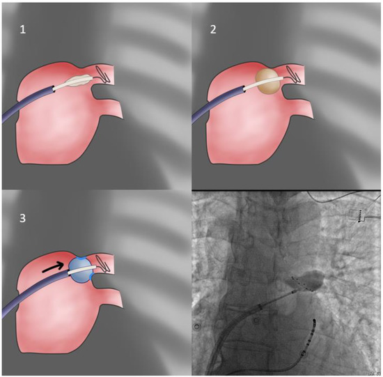 Best Practice Guide for Cryoballoon Ablation in Atrial Fibrillation ...