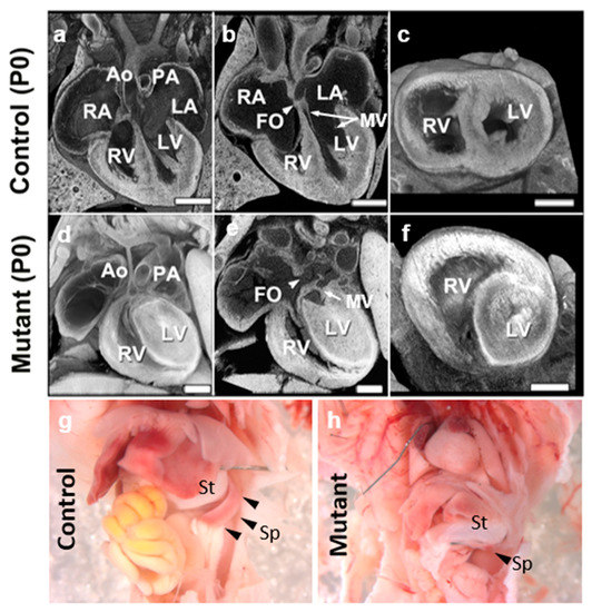 Left-Sided Heart Defects and Laterality Disturbance in Hypoplastic Left ...