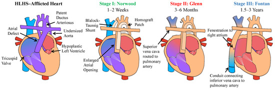 Tricuspid Valve Regurgitation in Hypoplastic Left Heart Syndrome: Current Insights and Future ...